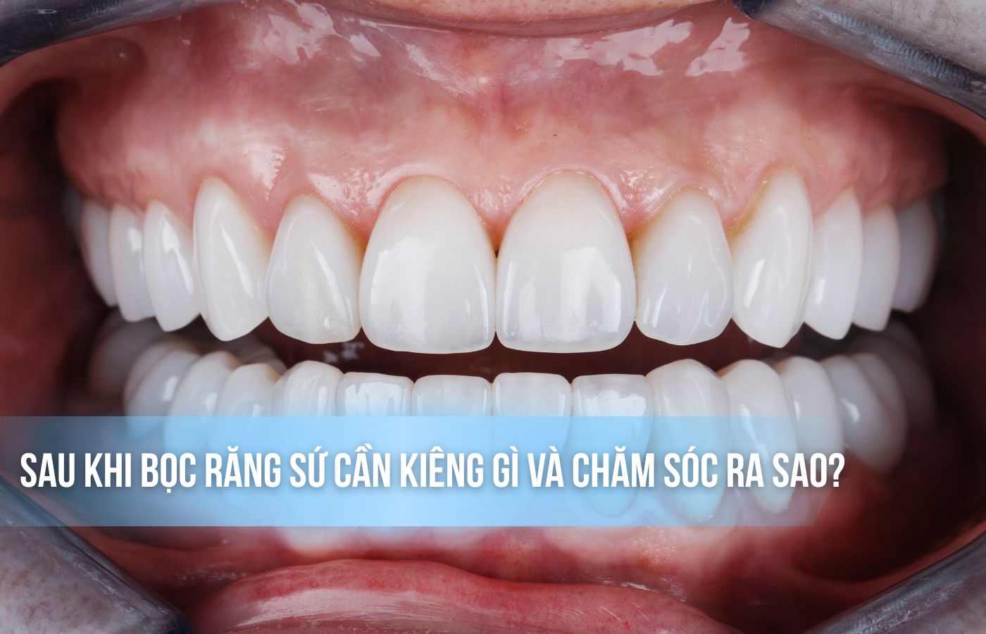 Sau khi bọc răng sứ cần kiêng gì và chăm sóc ra sao? - Nha Khoa Tường Minh