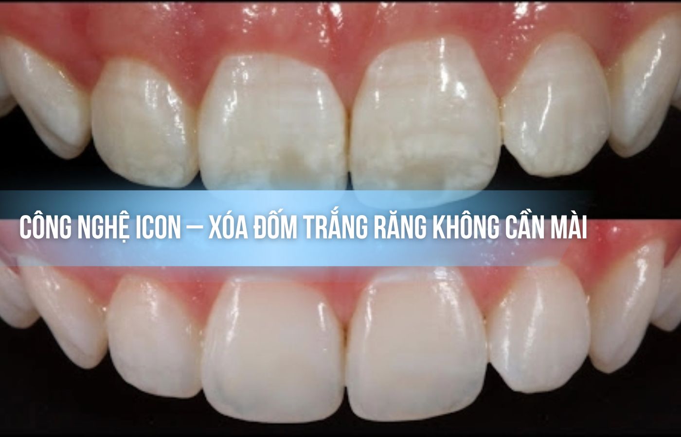 Công nghệ ICON – Xóa đốm trắng răng không cần mài - Nha Khoa Tường Minh